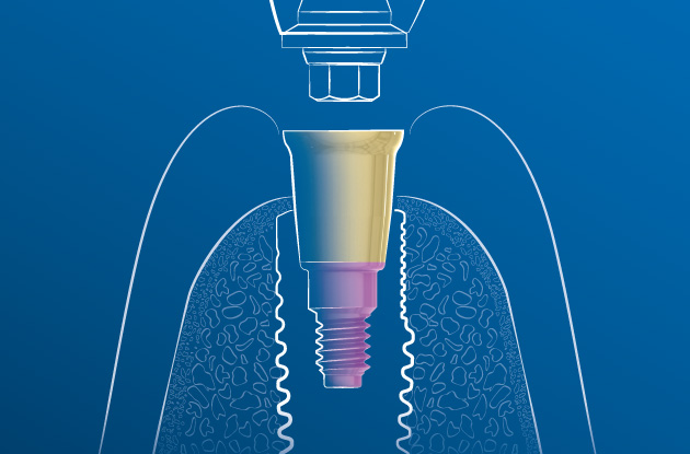 Comprehensive CONNECT Abutment System for a Screw Retained Solution ...