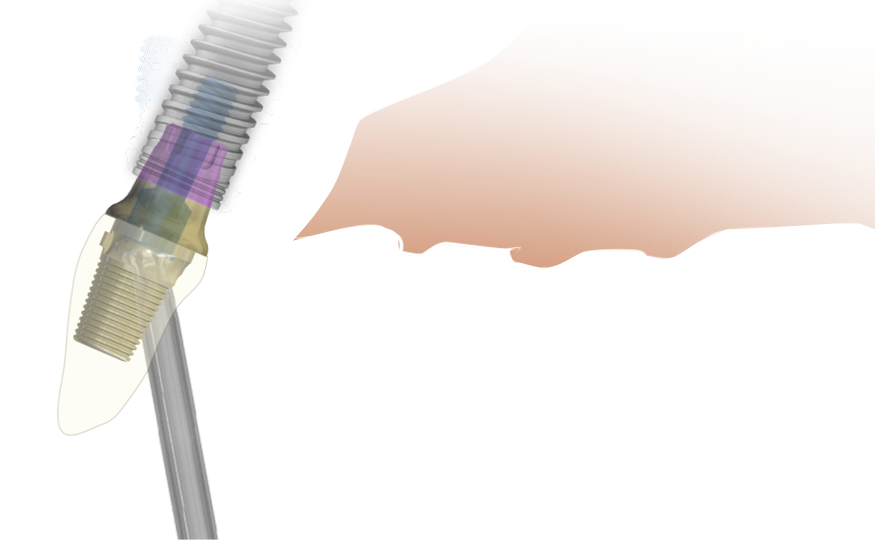 MIS - Dental Implants Technology | MIS Dental Implants